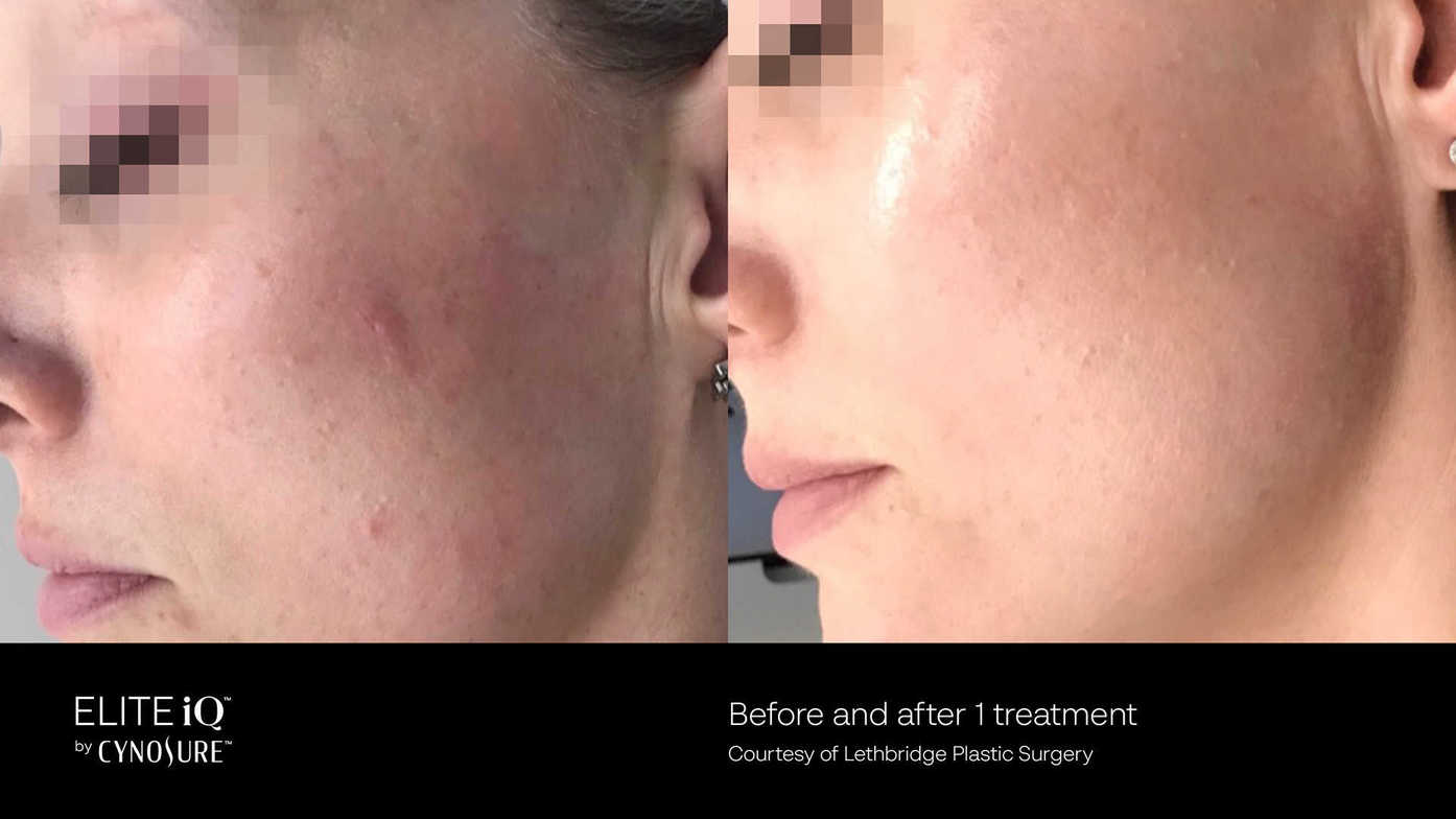 Laser Skin Rejuvenation | Cynosure Elite iQ Laser | Morphia Beauty Clinic