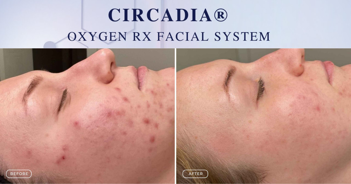 Breathe New Life Into Your Skin with the Oxygen Rx Facial | Facials ...